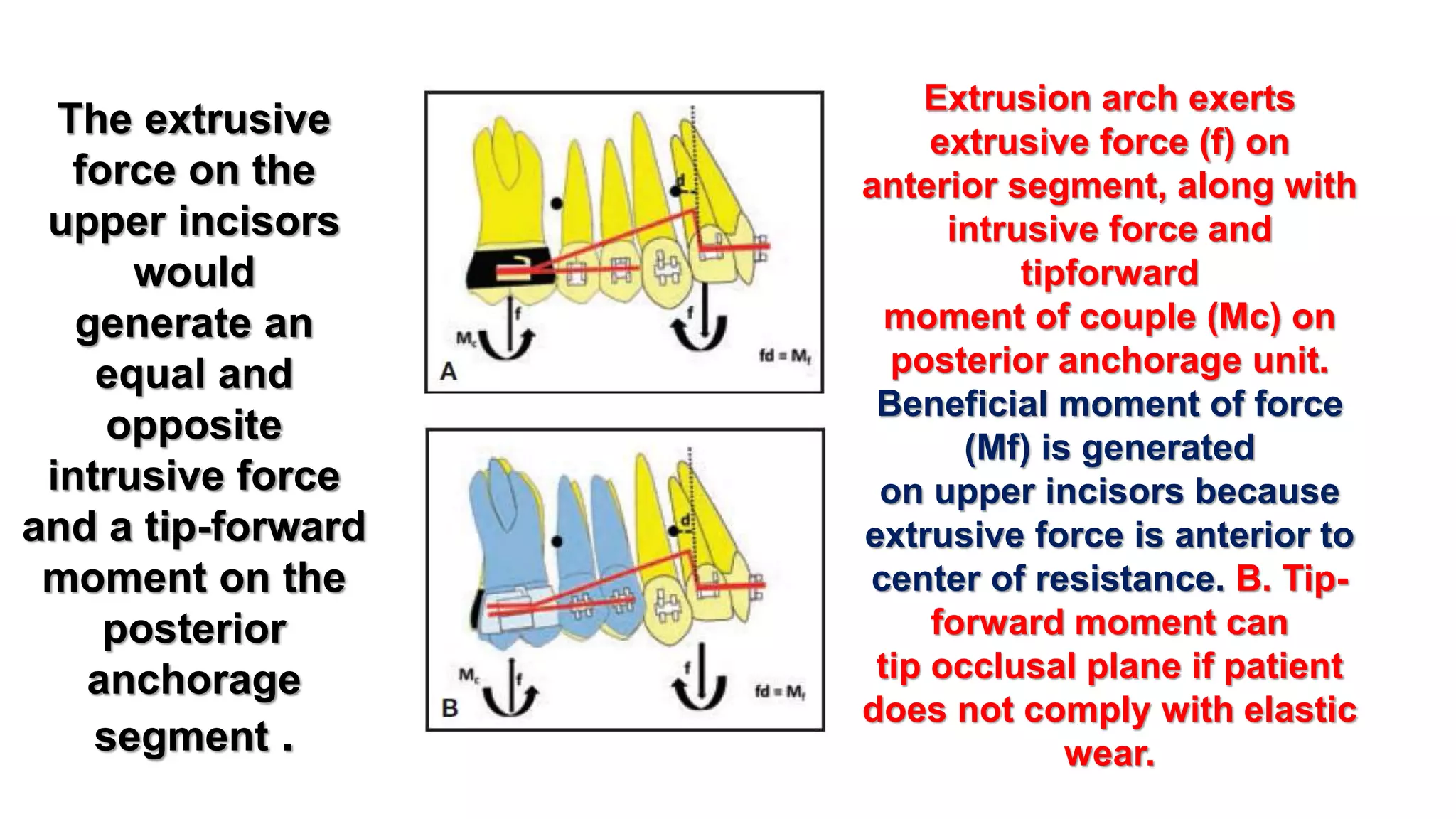 Biomechanics of the extrusion arches | PPTX