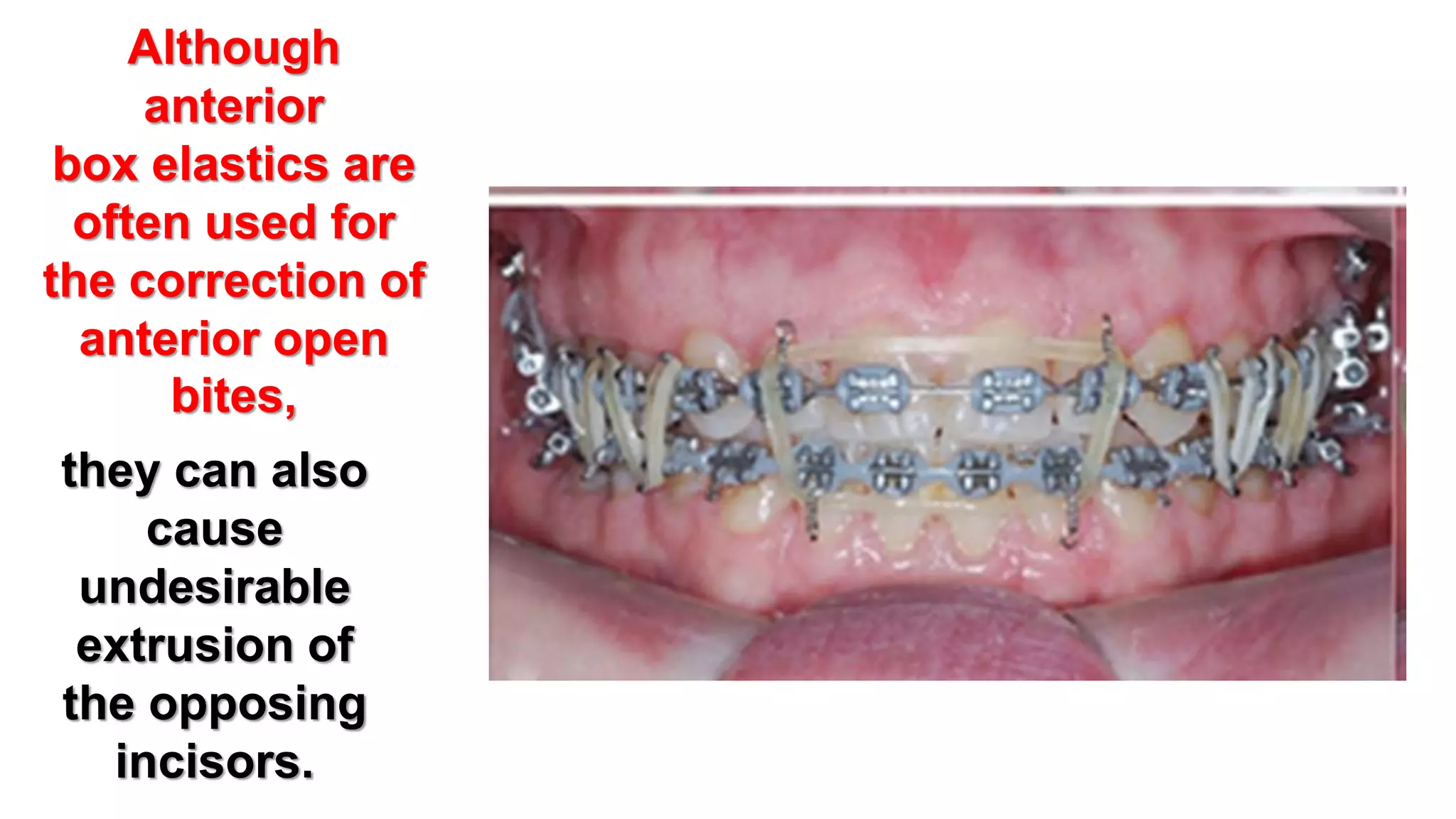 Biomechanics of the extrusion arches | PPTX