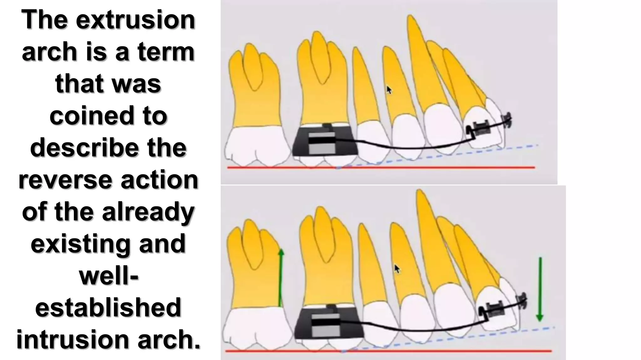 Biomechanics of the extrusion arches | PPTX