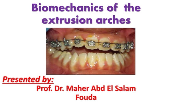 Biomechanics of the extrusion arches | PPTX | Dental Health | Diseases ...
