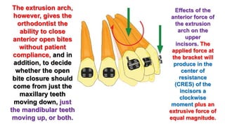 Biomechanics of the extrusion arches | PPTX