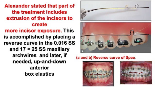 Biomechanics of the extrusion arches | PPTX | Dental Health | Diseases ...