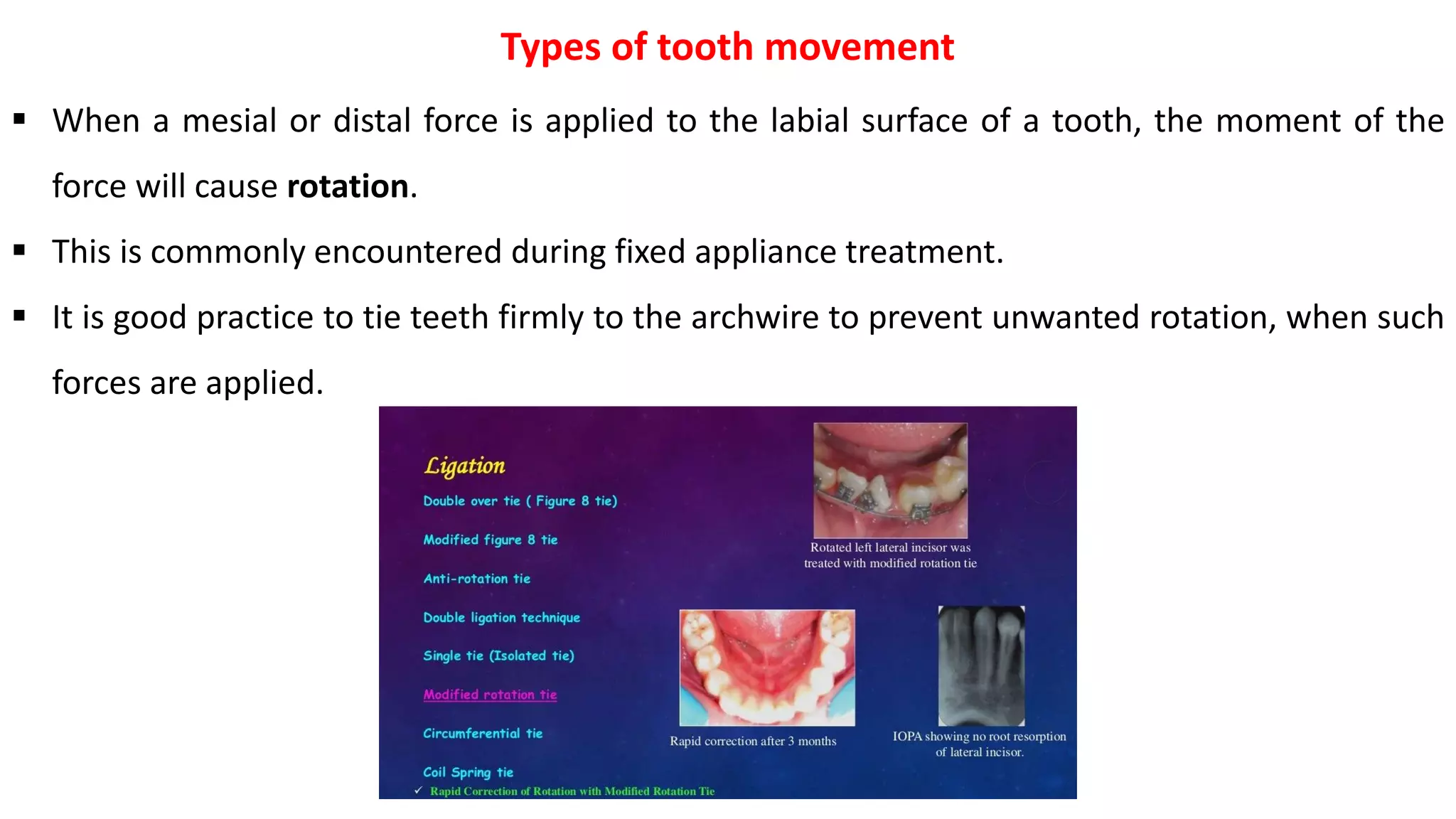 Biomechanics of Tooth Movement.pdf