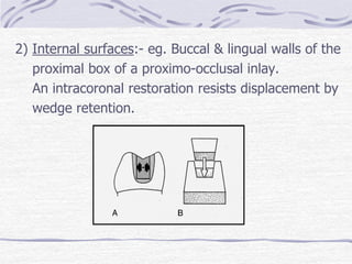 BIOMECHANICS OF TOOTH PREPARATION.ppt