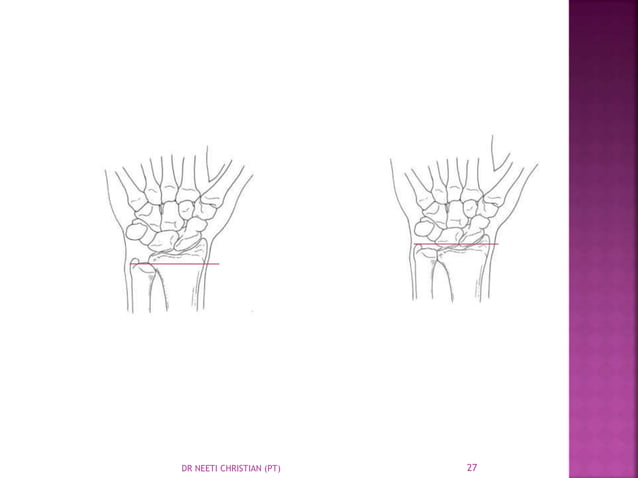 Biomechanics of wrist complex | PPTX