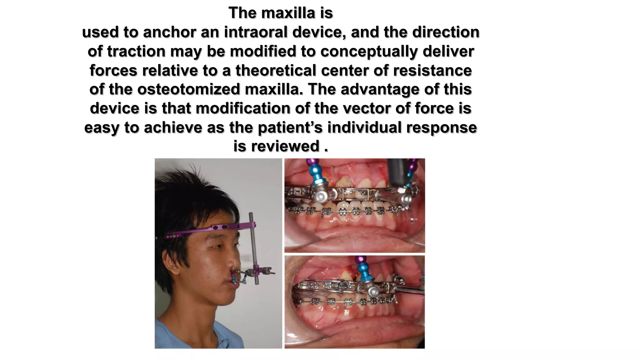 orthodontic biomechanics of skeleta deformities part 3 | PPTX