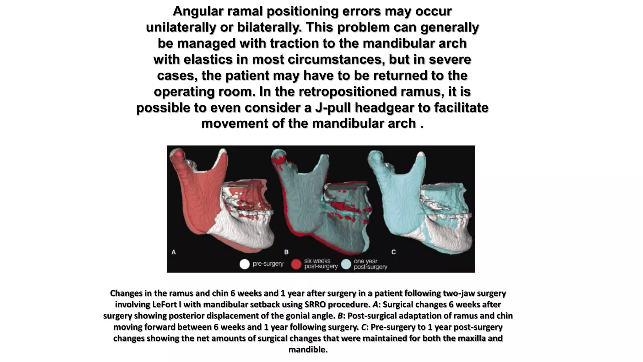 orthodontic biomechanics of skeleta deformities part 3 | PPTX