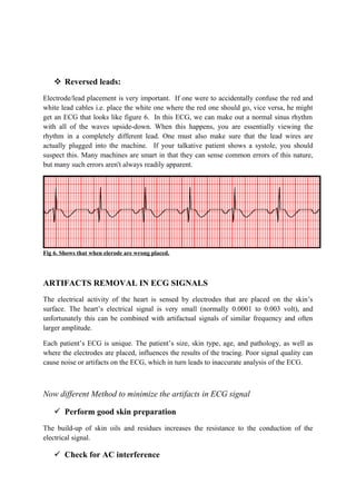 various type of artifacts in ECG signal & how it's remove | DOC