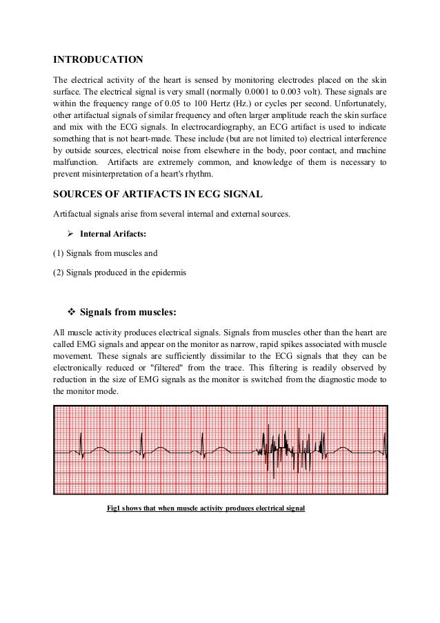 various type of artifacts in ECG signal & how it's remove