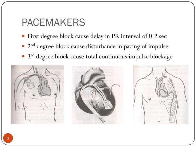 Biomedical equipments- Pacemakers and Defibrillators | PPT