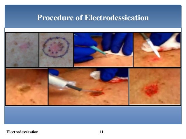 Electrodessication Bio Medical Instrumentation