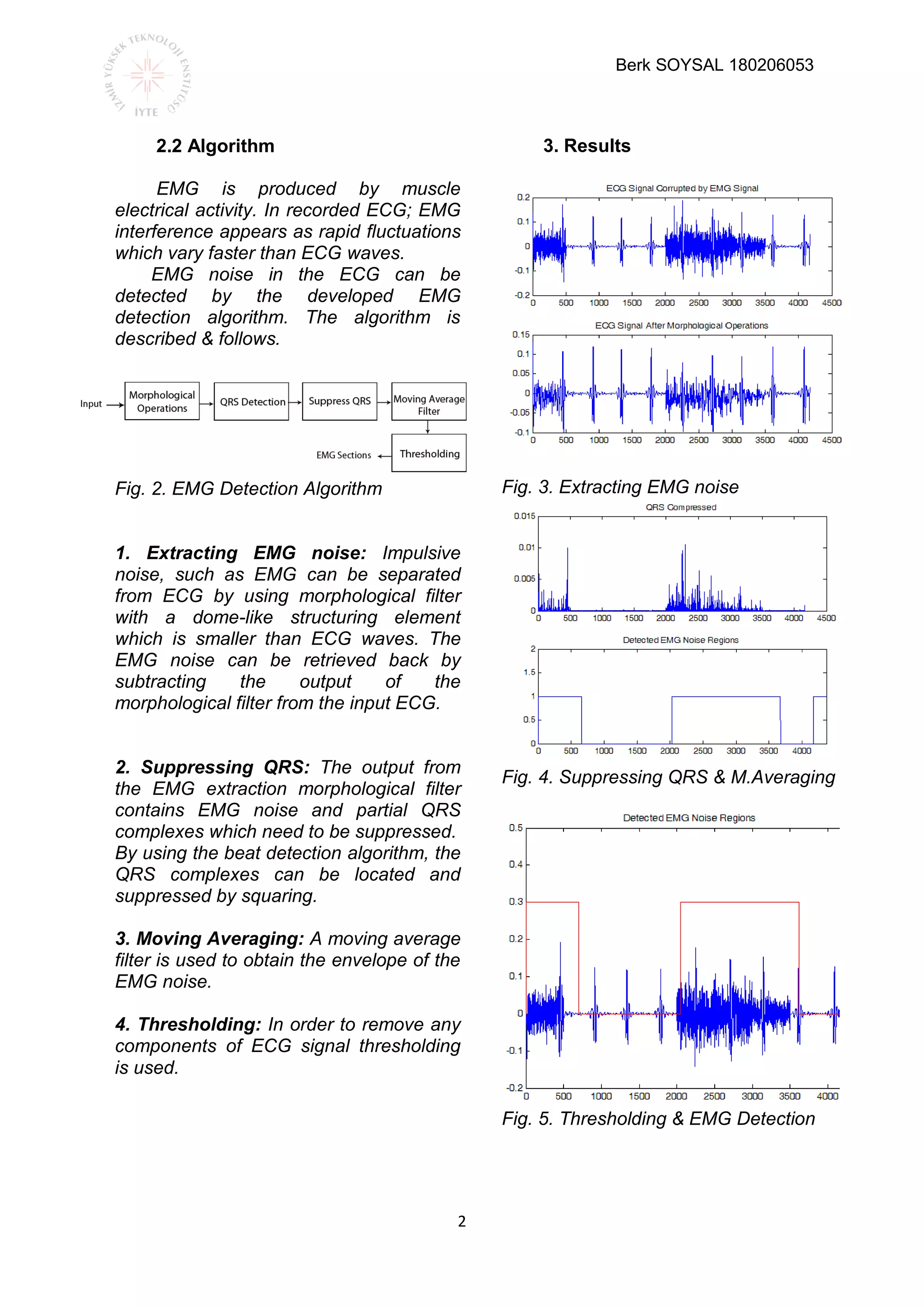 Biomedical project report detecting emg noise | PDF