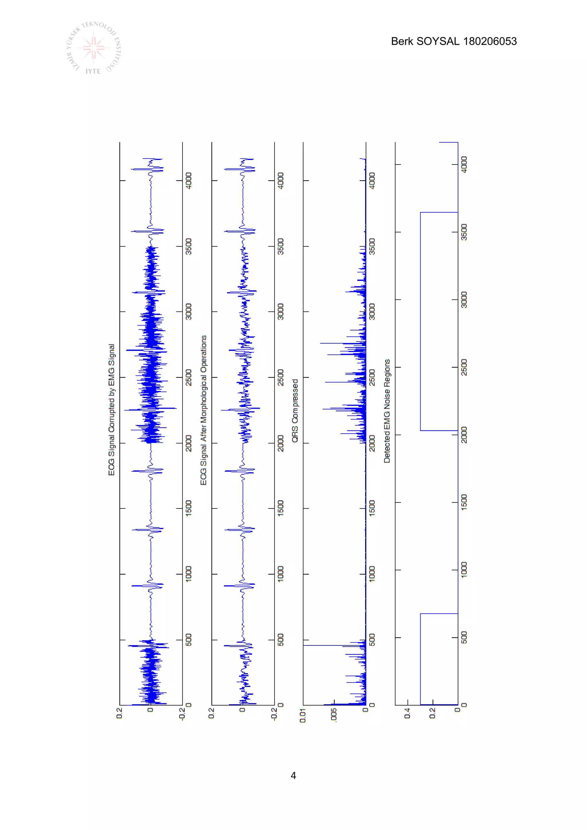 Biomedical project report detecting emg noise | PDF