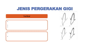 Biomekanik Perawatan Ortodonti pada Sistem Stomatognati | PPTX