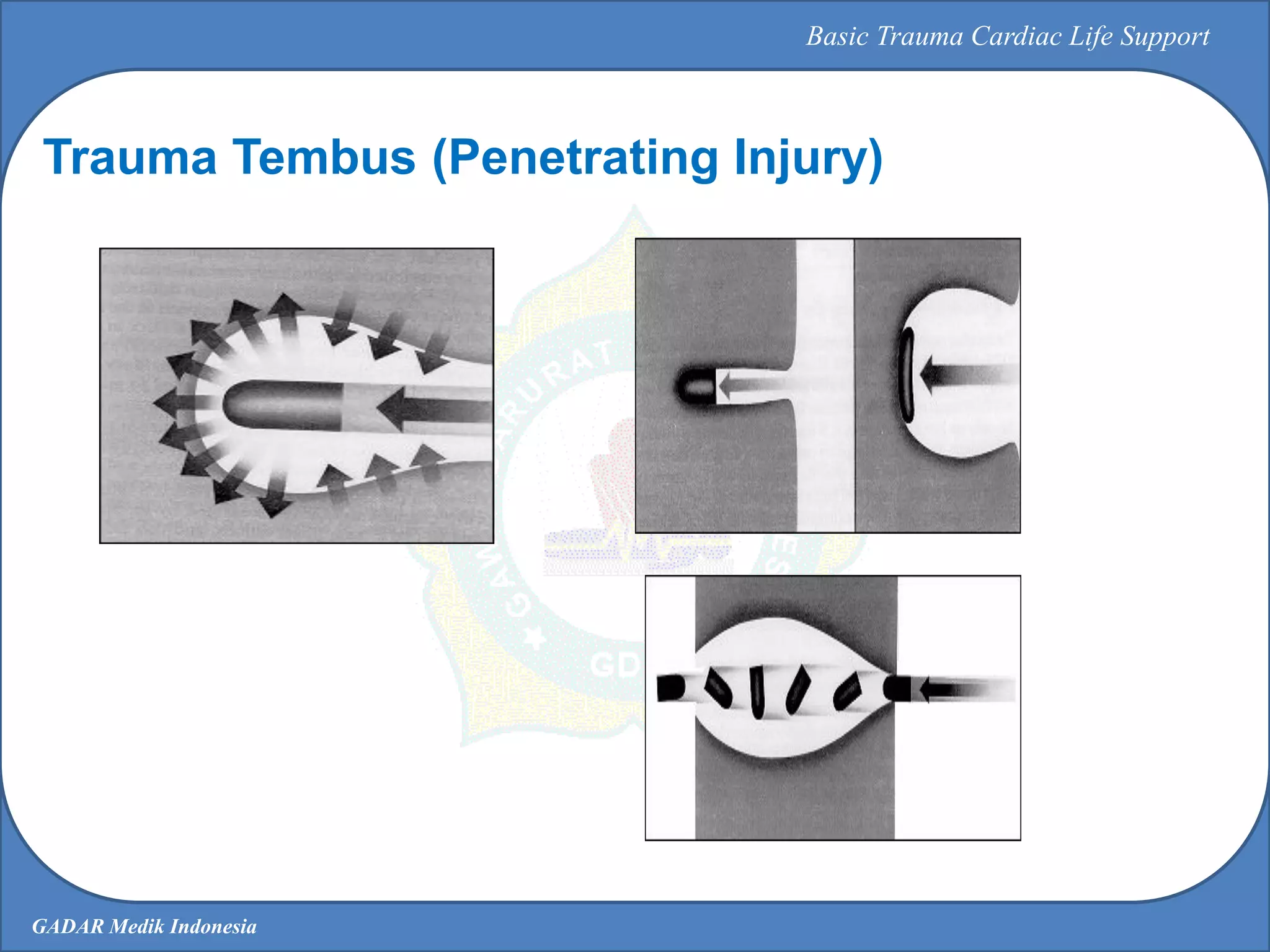 Biomekanik Trauma | PDF