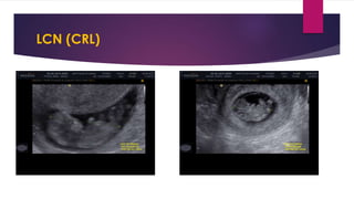 Ecografia Obstetrica (Biometria Fetal) | PPTX