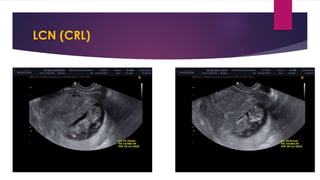 Ecografia Obstetrica (Biometria Fetal) | PPTX