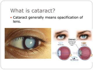 Biomety for cataract by rachana | PPTX
