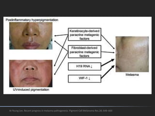 Biomolecular aspects of hyperpigmentation disorders | PPTX