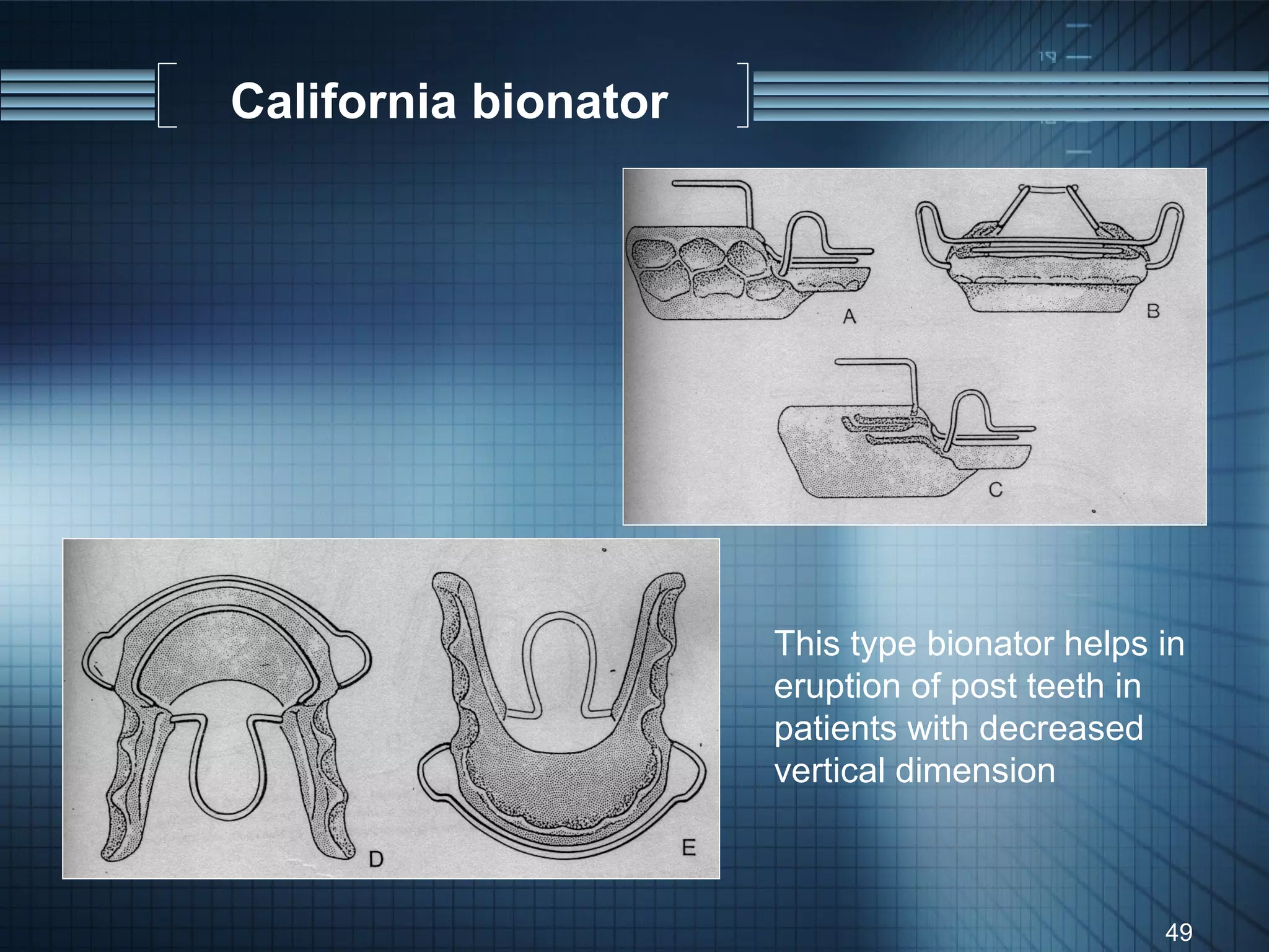 Bionator | PPT