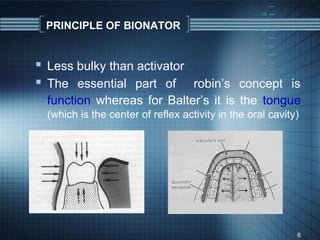 Bionator | PPT