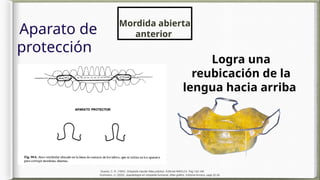 Bionator clase 1,2 y 3 , aparatologia ortopédica para maloclusiones | PPTX