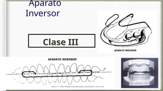 Bionator clase 1,2 y 3 , aparatologia ortopédica para maloclusiones | PPTX