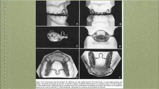 Bionator clase 1,2 y 3 , aparatologia ortopédica para maloclusiones | PPTX