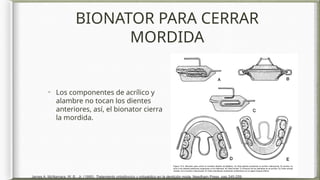 Bionator clase 1,2 y 3 , aparatologia ortopédica para maloclusiones | PPTX