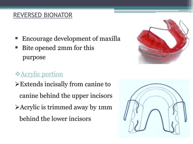 bionator | PPTX | Dental Health | Diseases and Conditions