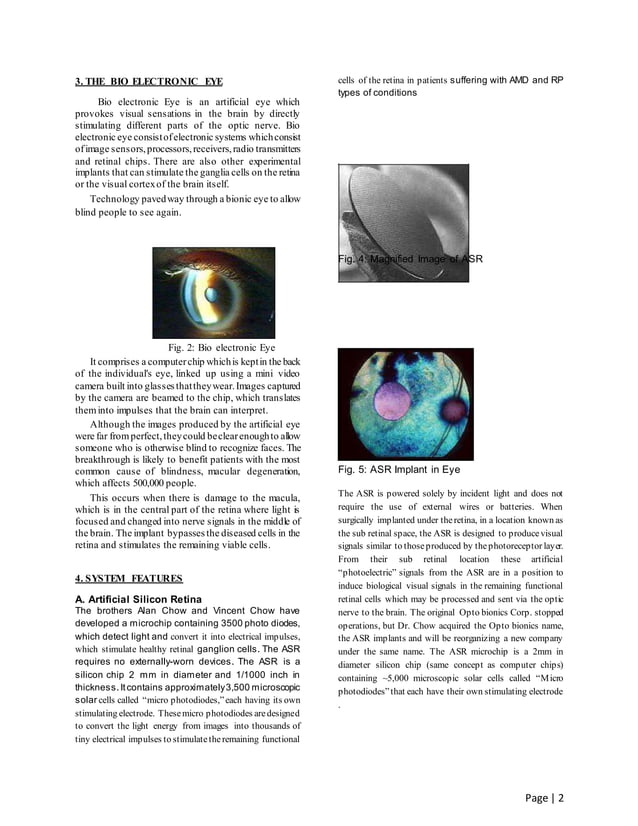 Bionic eye | DOCX | Eye and Vision Conditions | Diseases and Conditions