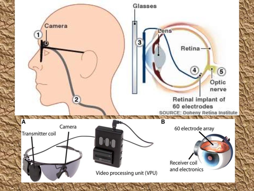 Bionic eye