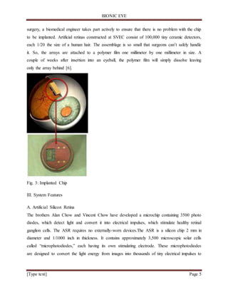 Bionic eye | DOCX