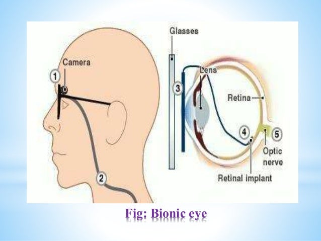 Bionic eye