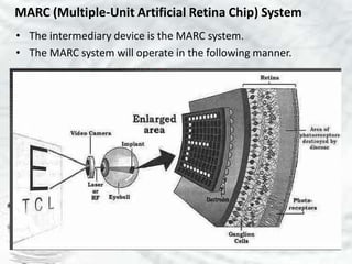 Bionic eye | PDF
