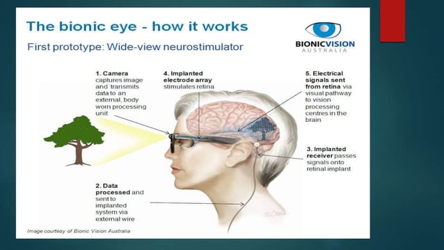 Bionic eye.pptx
