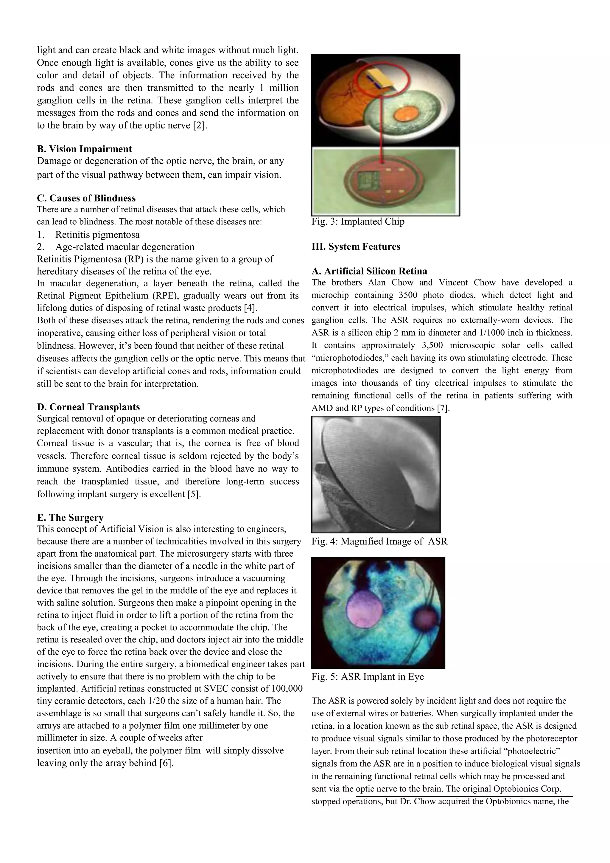Bionic eye hard copy | PDF