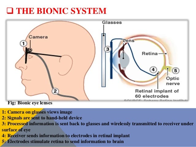 Bionic Eye