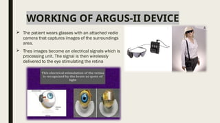 BIONIC EYE FINAL.pptx hhhhhhhhhhhhhhhhhhhh | PPT