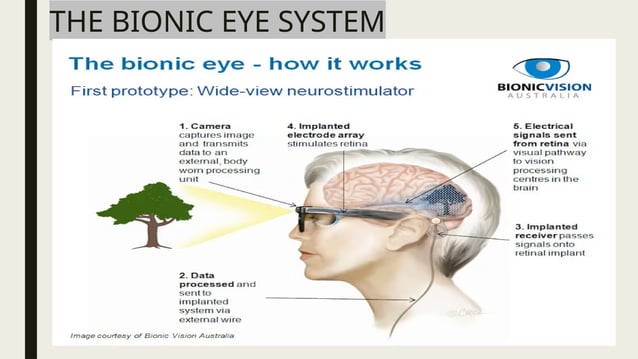 BIONIC EYE FINAL.pptx hhhhhhhhhhhhhhhhhhhh | PPT