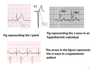 BIOPOTENTIAL RECORDERS(ECG,EEG,EMG)EXPLANATION | PPTX