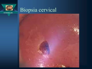 Biopsia cervical | PDF
