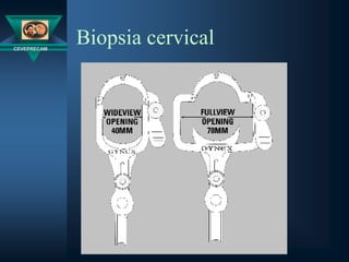 Biopsia cervical | PDF
