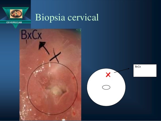 Biopsia cervical
