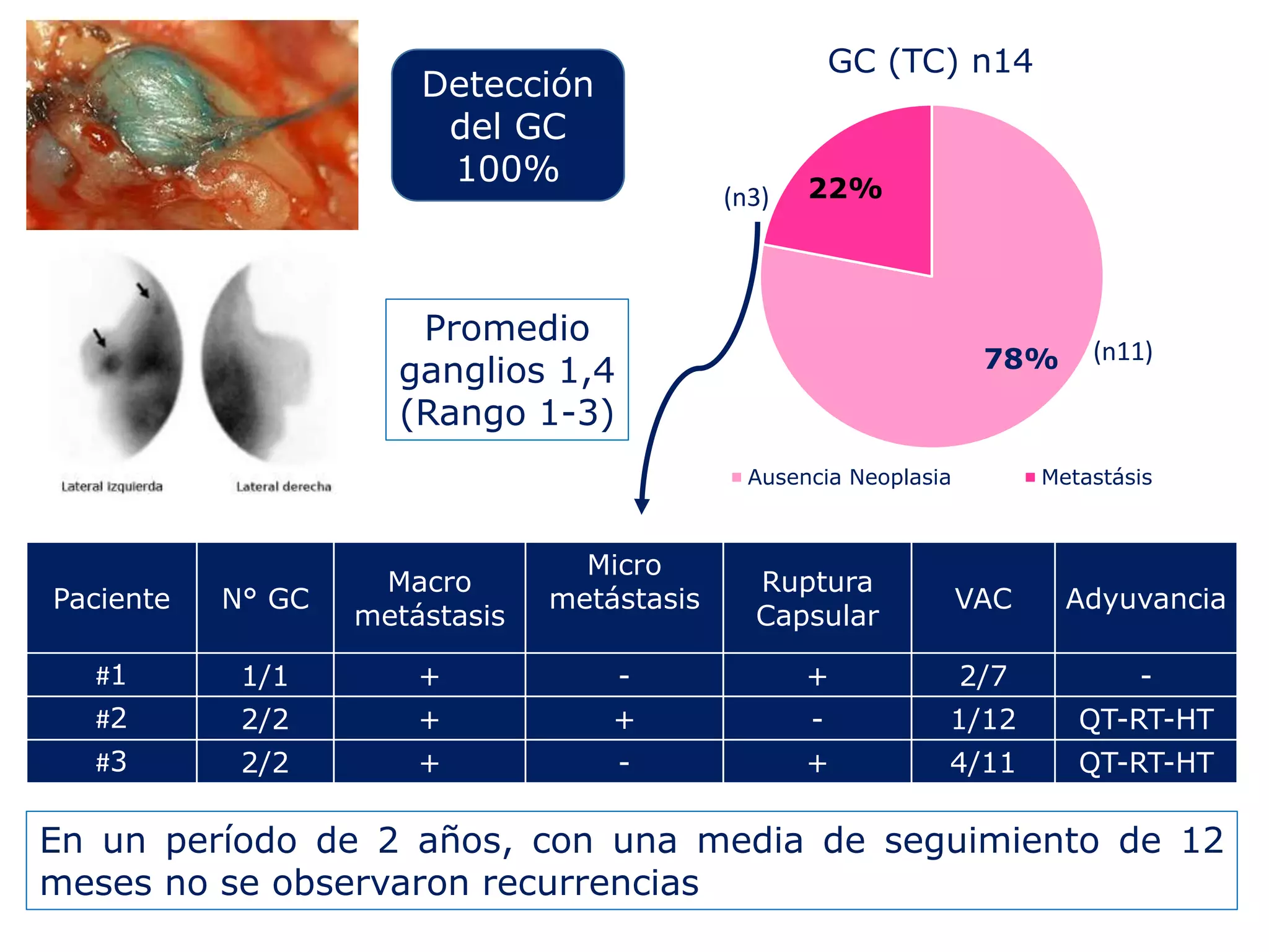 Biopsia de ganglio centinela (técnica combinada) en cáncer de mama | PPTX