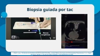 biopsia pleural, TECNICA, INDICACIONES Y CONTRAINDICACIONES | PPTX