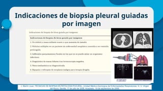 biopsia pleural, TECNICA, INDICACIONES Y CONTRAINDICACIONES | PPTX