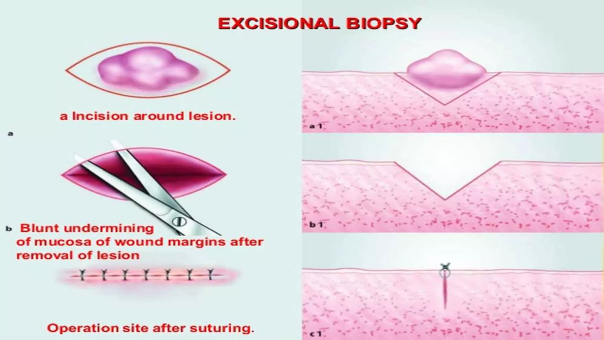 BIOPSY | PPTX