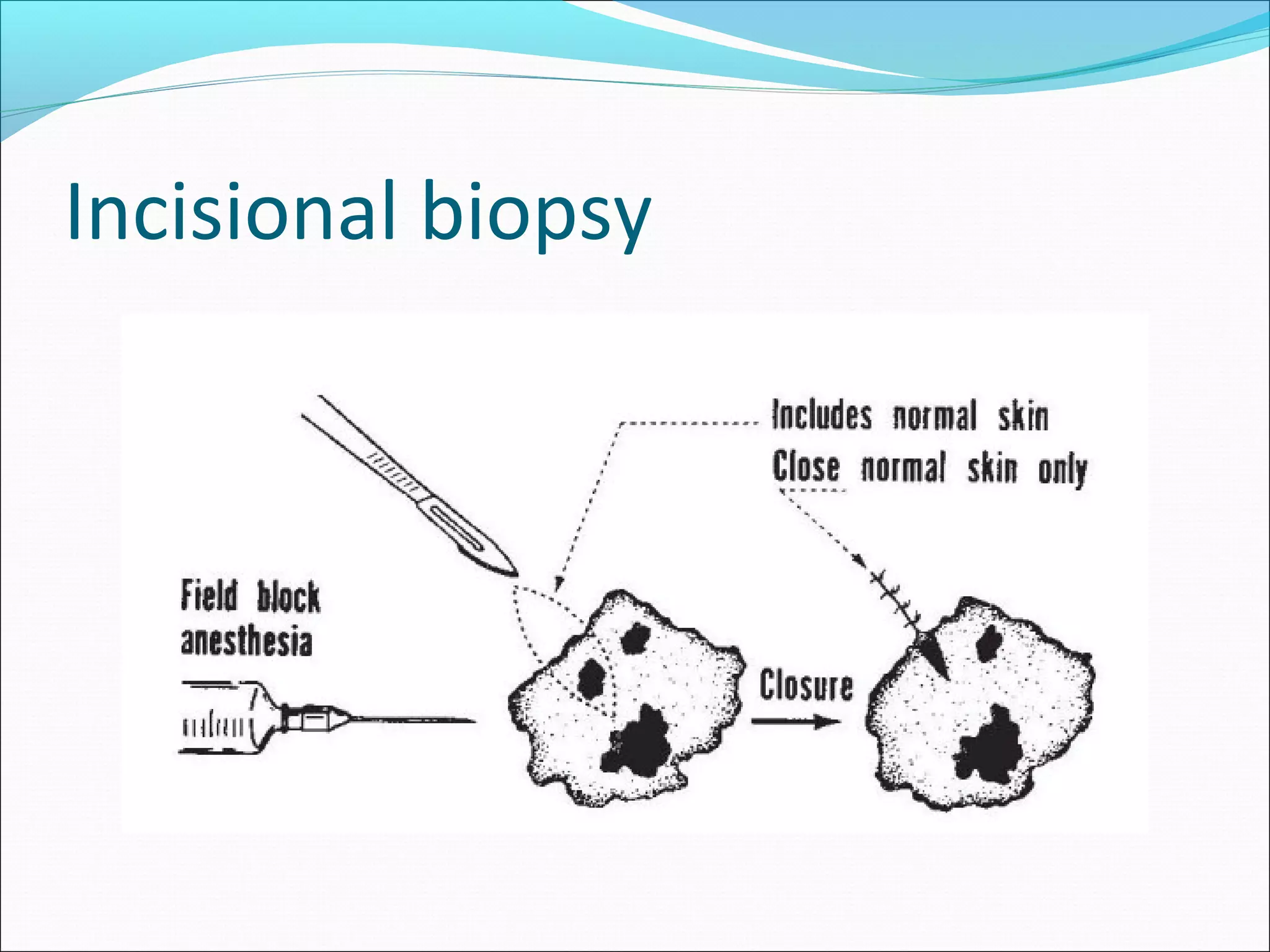 Biopsy | PPT