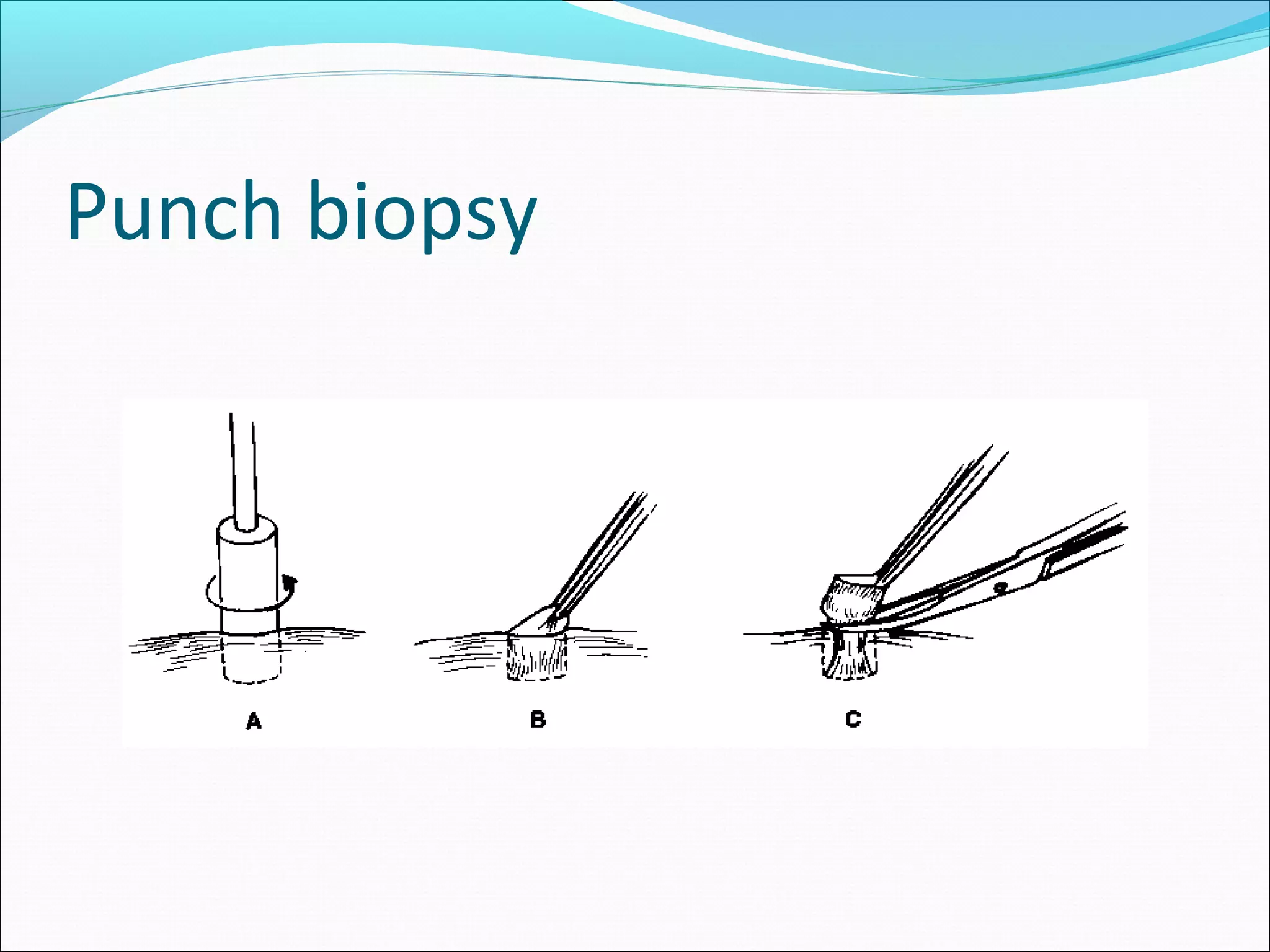 Biopsy | PPT